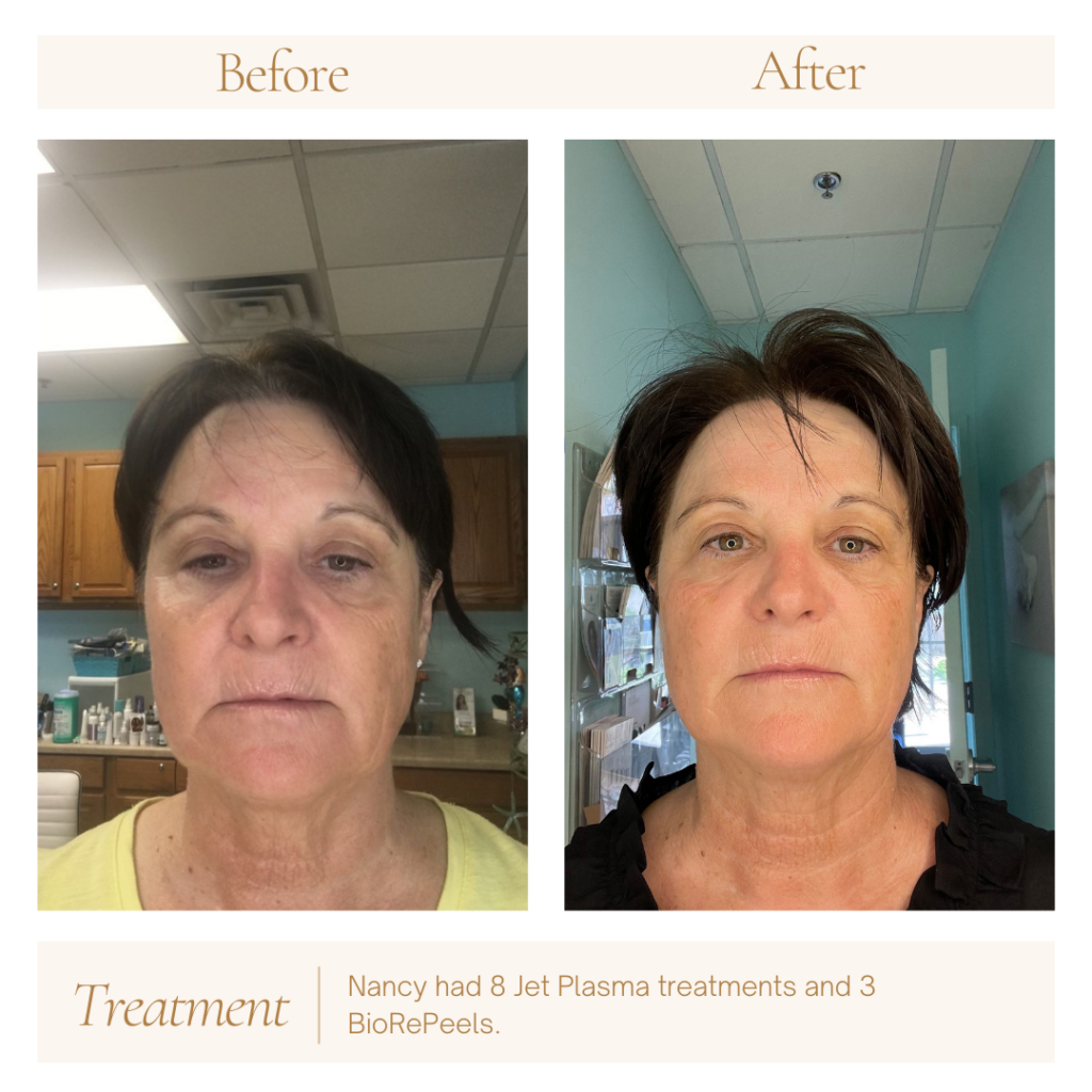 Client Before/After Treatment • Sleekskin® Aesthetics of Scottsdale AZ ...